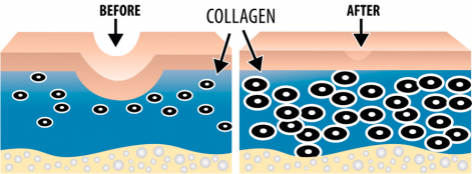 Collagen Induction Therapy | Elite Skin and Esthetics